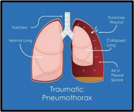 Chest Tubes - The Blog - Nicole Kupchik Consulting and Education